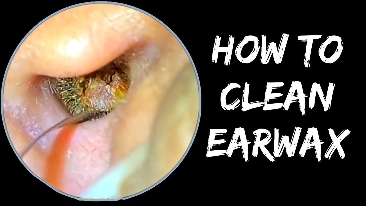 " SATISFYING " : earwax removal earcleaning. #removal #earwaxremoval # ...