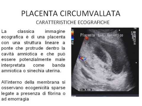 Placenta circumvallata - YouTube