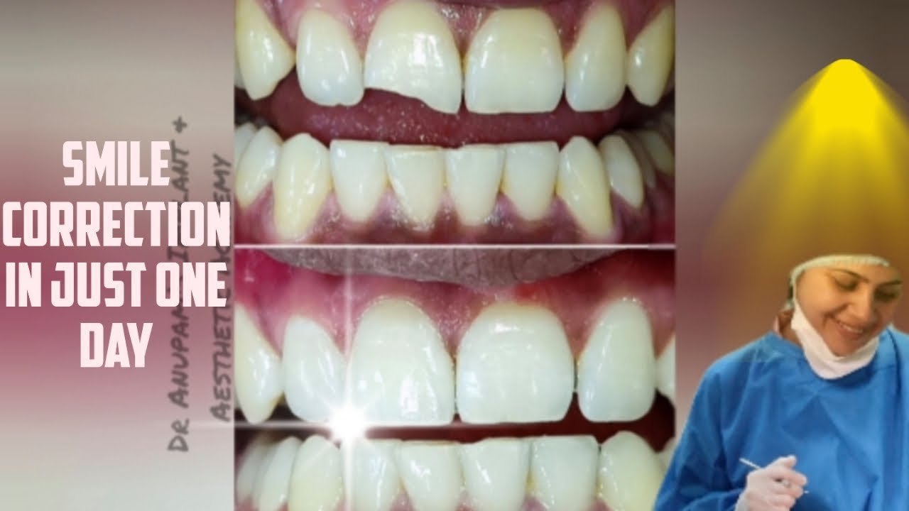 Smile correction in just one day! #cosmeticdentistry #dentist #dental # ...