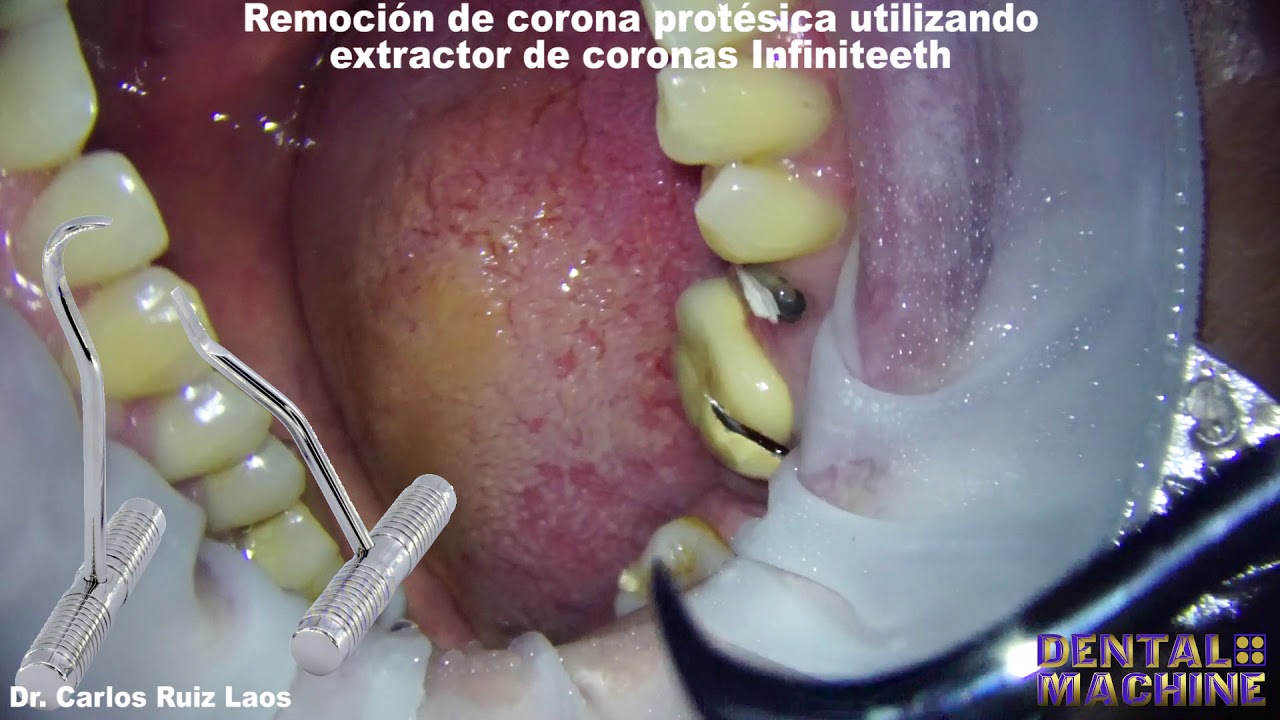 EXTRACTOR DE CORONAS INFINITEETH - YouTube