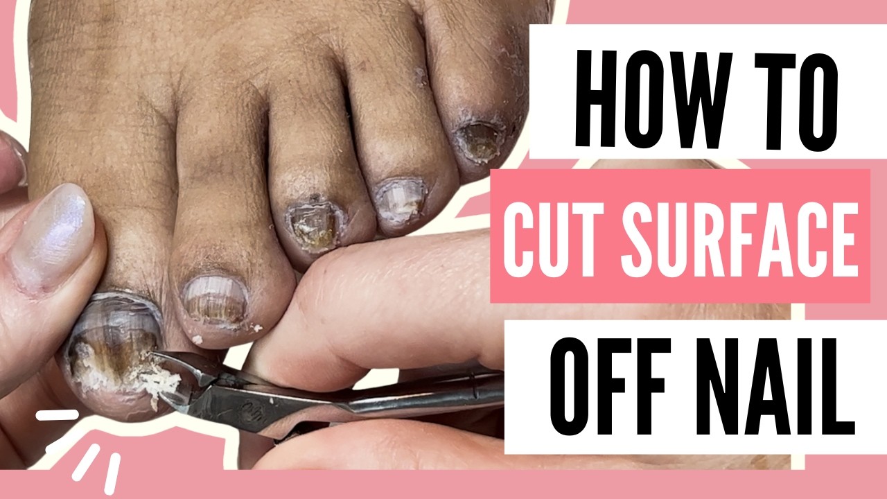 How to Fix Nail Fungus Toenails at Home No Medication - YouTube