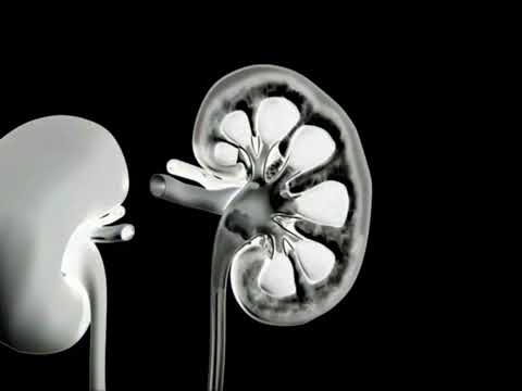 Böbrek Taşı Ameliyatı Nasıl Yapılır? Perkütan Nefrolitotomi (PNL) ×Basit Anlatım