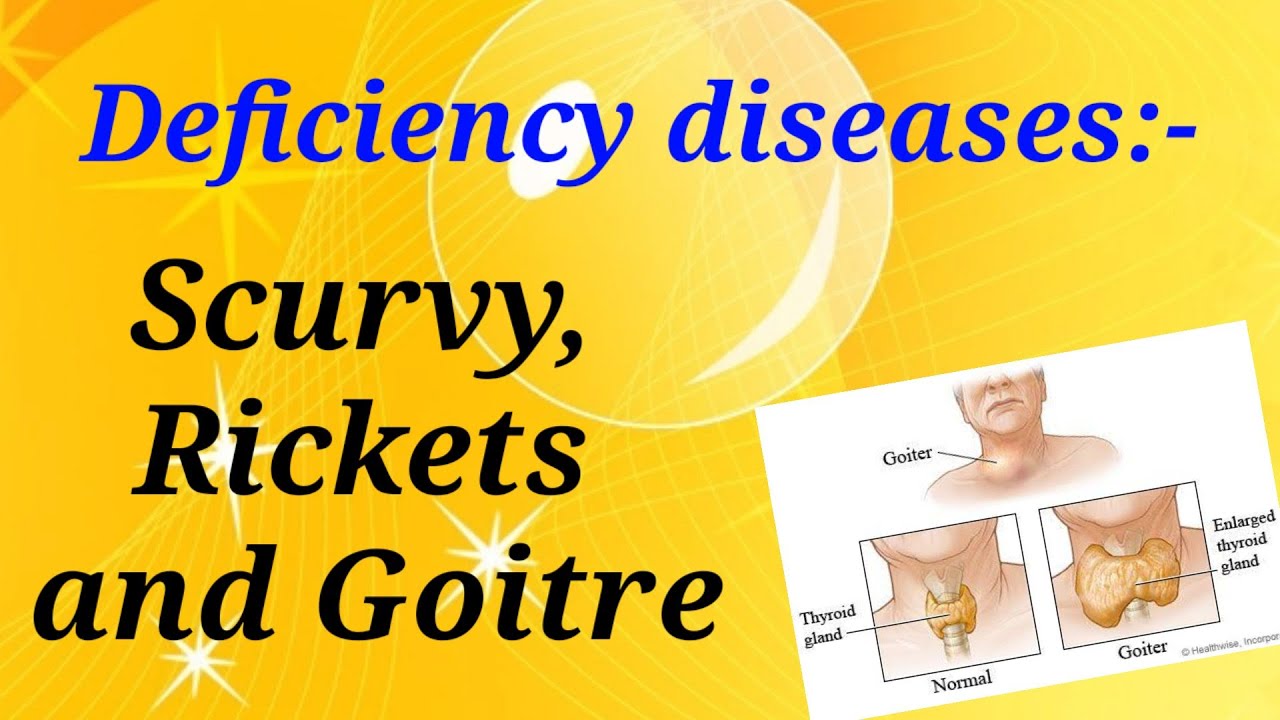 #scurvy #rickets #goitre Deficiency diseases:-scurvy,rickets and goitre ...