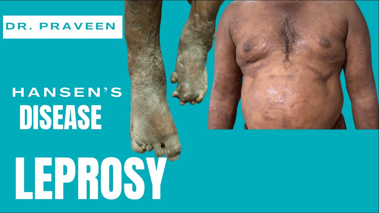 HANSEN'S DISEASE | LEPROSY | CAUSE, PRESENTATION, DIAGNOSIS AND ...