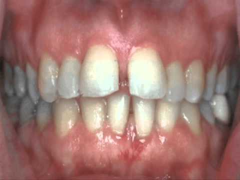 Ortodontia dentes em movimento dentes com espaço diastema anterior ...