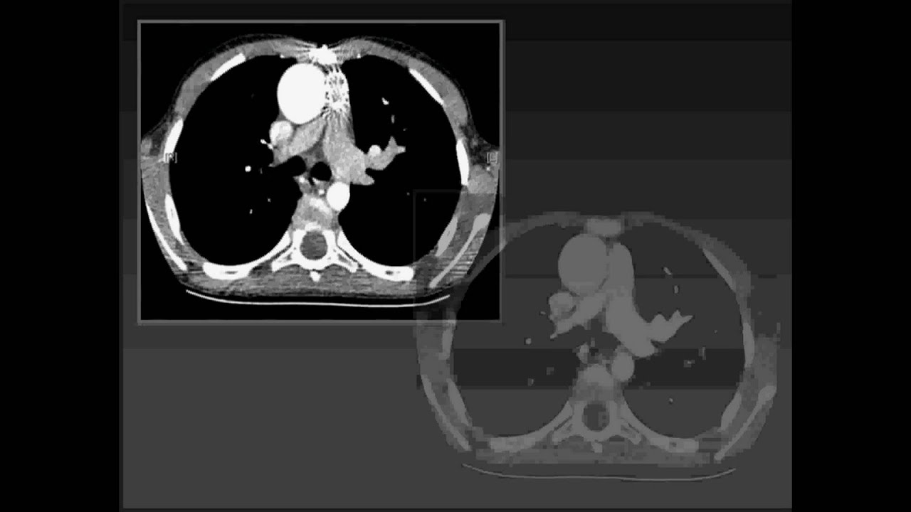 Cardiac CT in Pediatircs Part 1 - YouTube