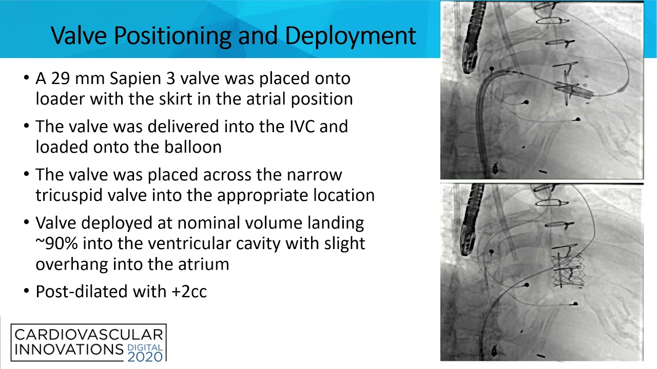 Sullivan_Transcatheter Valve in Valve Replacement for Severe ...