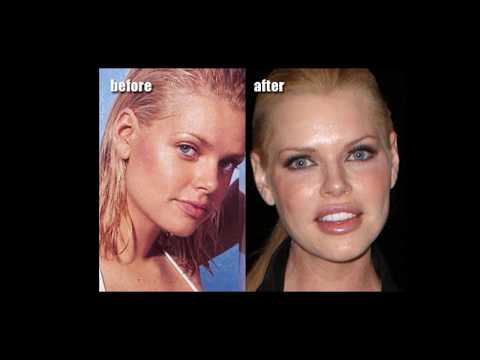 Top 22 Best Celebrities Before and After Plastic Surgery