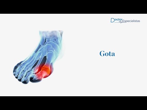 Enfermedad de la Gota (artritis inflamatoria) - Doctores Especialistas ...