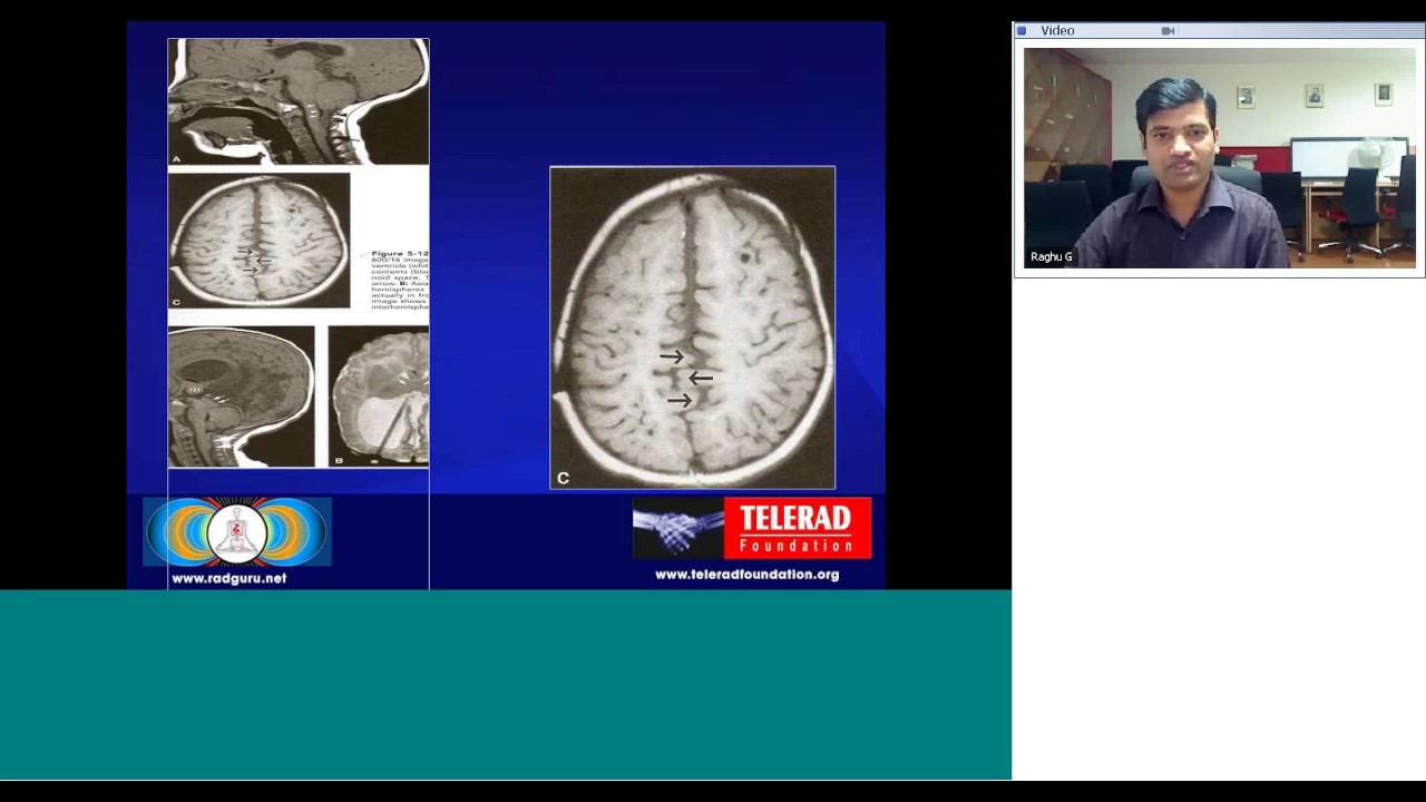 Congenital CNS anomalies by Dr Raghu.G - YouTube