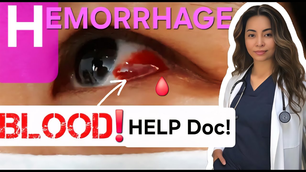 MANAGE YOUR EYE BLEED AT HOME: Easy Doctor Tips #visioncare #eyehealth ...