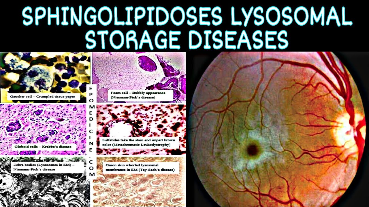 Sphingolipidoses Lysosomal storage diseases|Proff|NEET PG|NEXT|USMLE ...