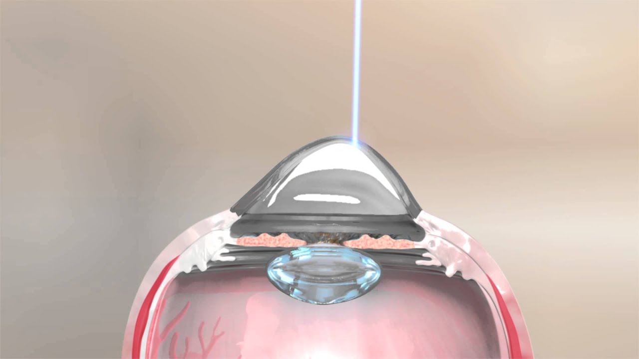 Topography Guided PRK with Simultaneous Collagen Cross Linking - YouTube