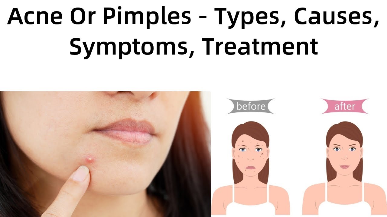 Acne Or Pimple - Types, Symptoms, Causes And Treatment - YouTube
