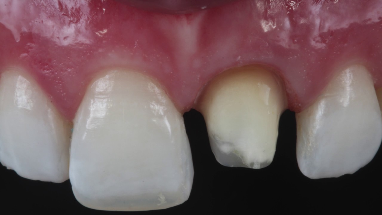 Preparo e moldagem para coroas totais - YouTube