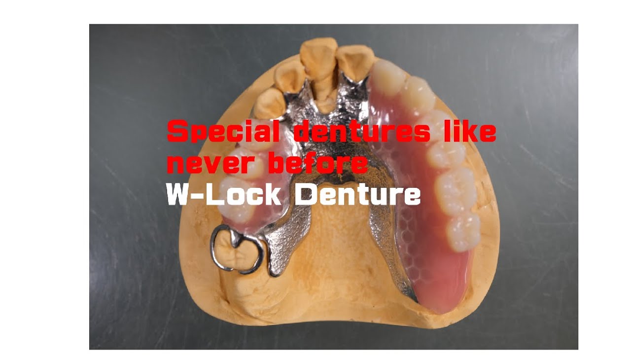 W-Lock Denture. - YouTube