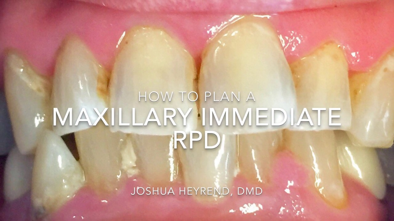How to Plan a Maxillary Immediate RPD - YouTube