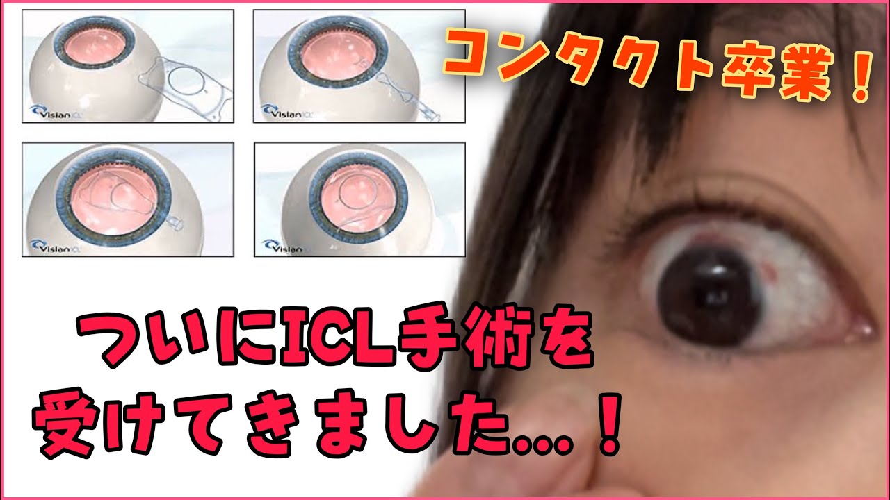 【ICL手術】ICL手術を受けてきました...！ - YouTube