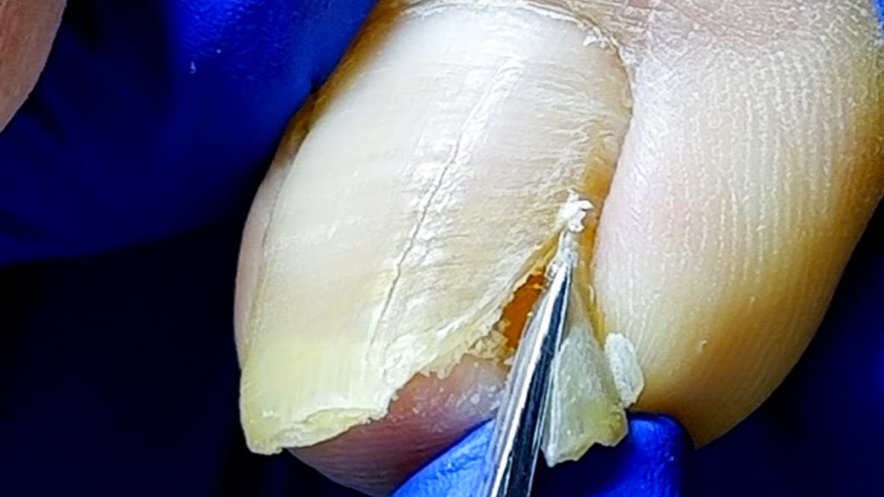 Ingrown Toenail Trim Beautiful Toenails【xue Yidao Pedicure】 Youtube