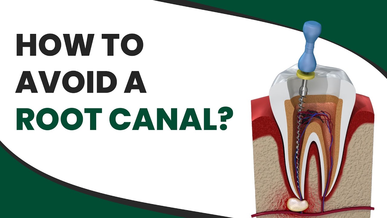 How to Avoid a Root Canal? - YouTube