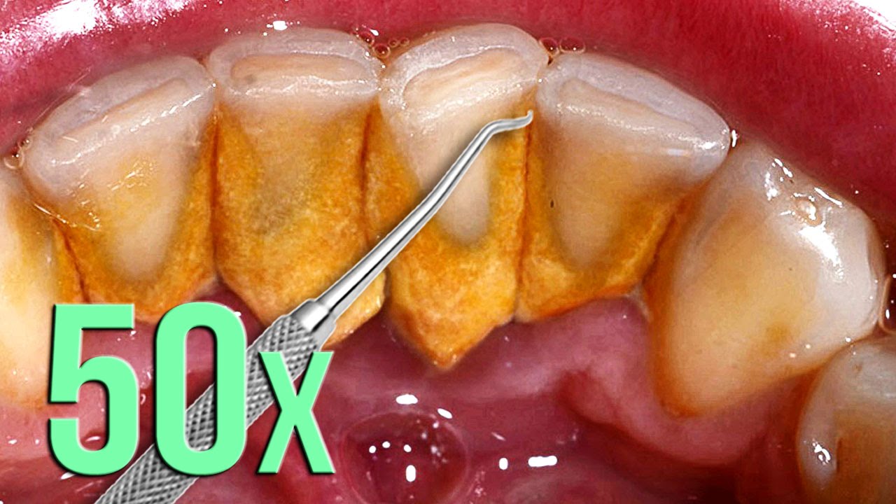 Worst Tartar & Plaque - Ugly Mouth Cleaning (HOT) - YouTube