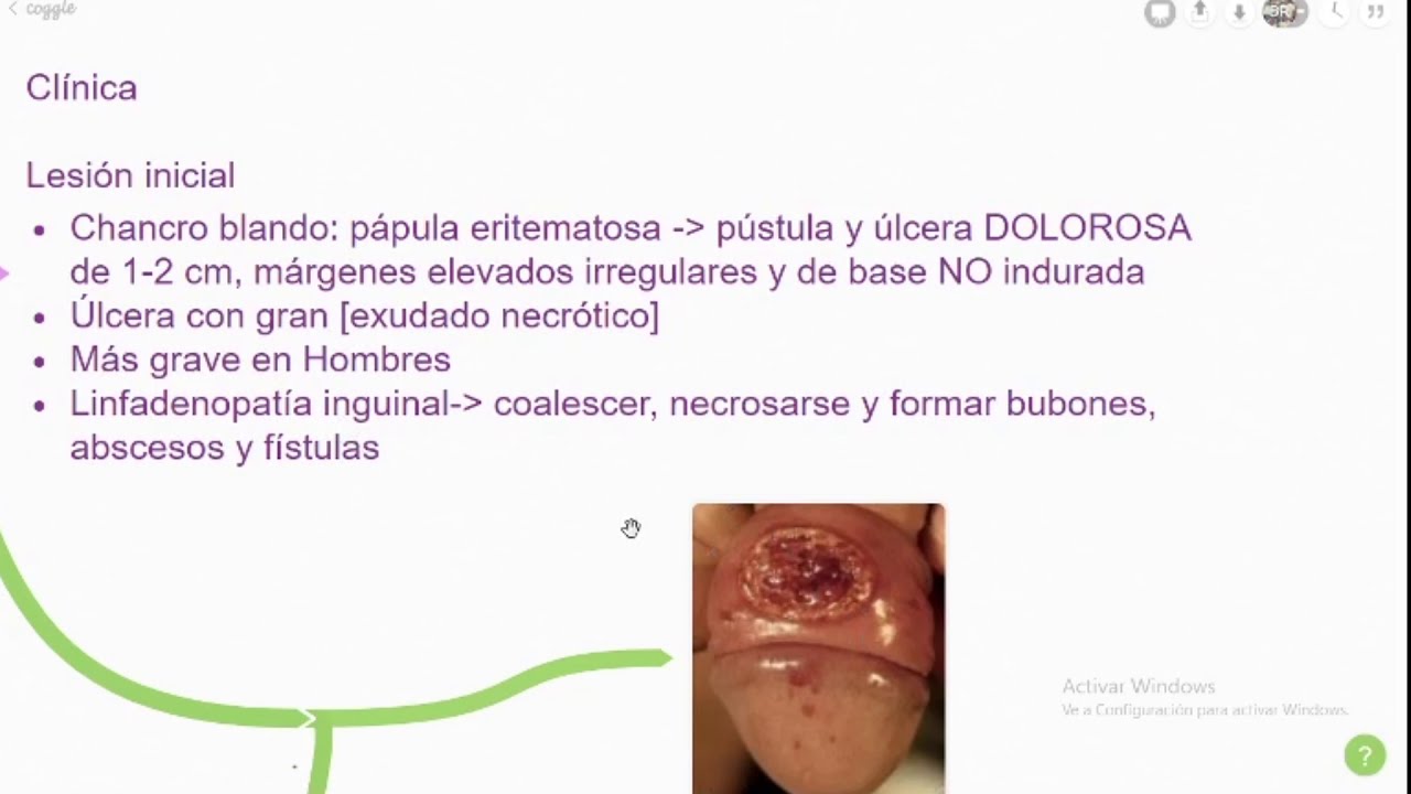 Qu Es El Chancro Blando O Chancroide Vacunas Para Viajar