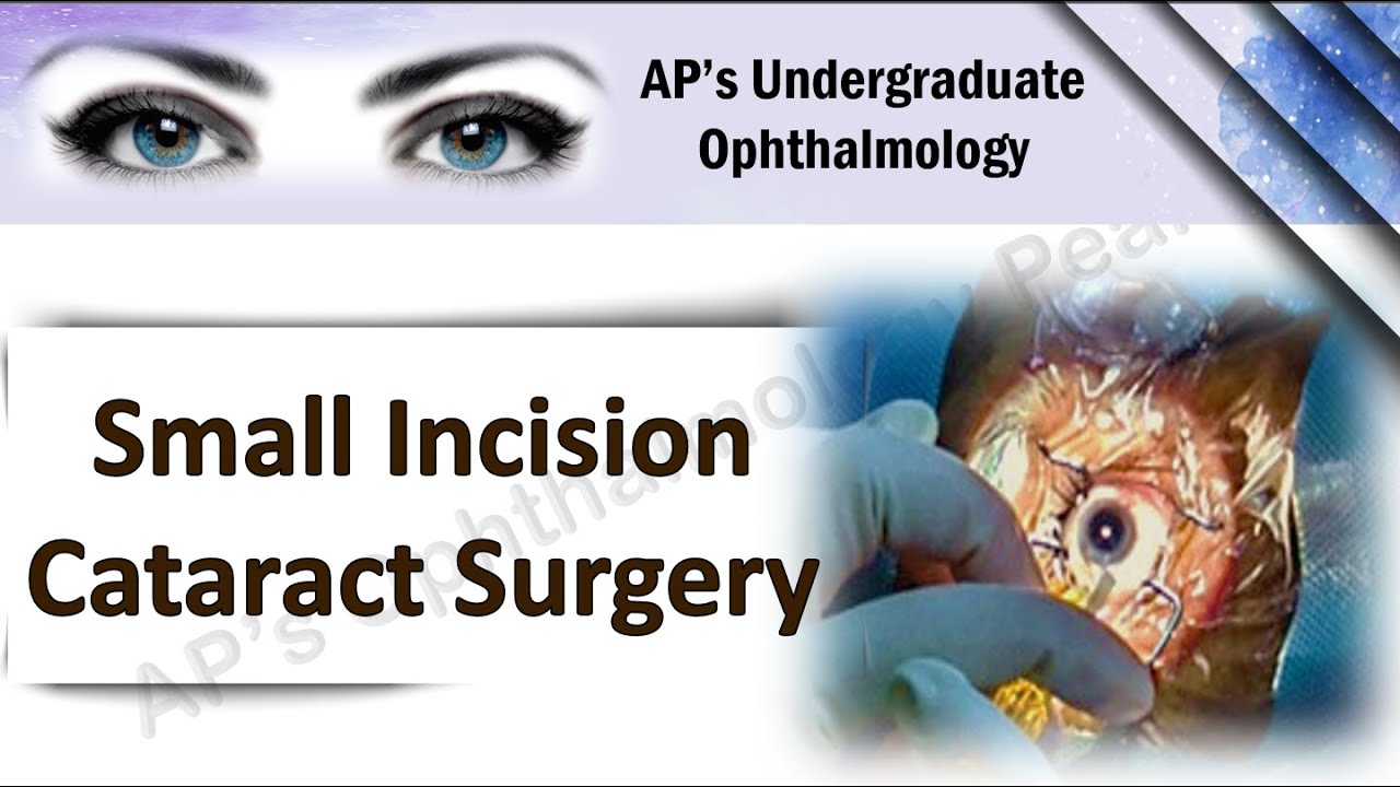Small Incision Cataract Surgery | SICS | AP'S Undergraduate ...
