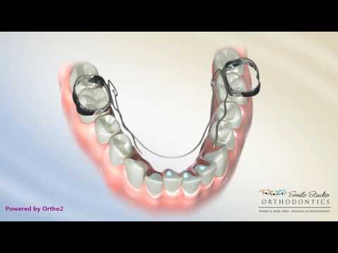 Bi Helix-Lower Orthodontic Appliance - YouTube