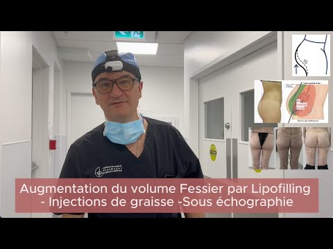 AUGMENTATION DES FESSES PAR LIPO-SCULPTURE - INJECTIONS DE GRAISSE SOUS ...