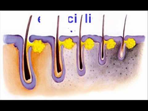 Tratamiento medico calvicie - Microtransplante capilar