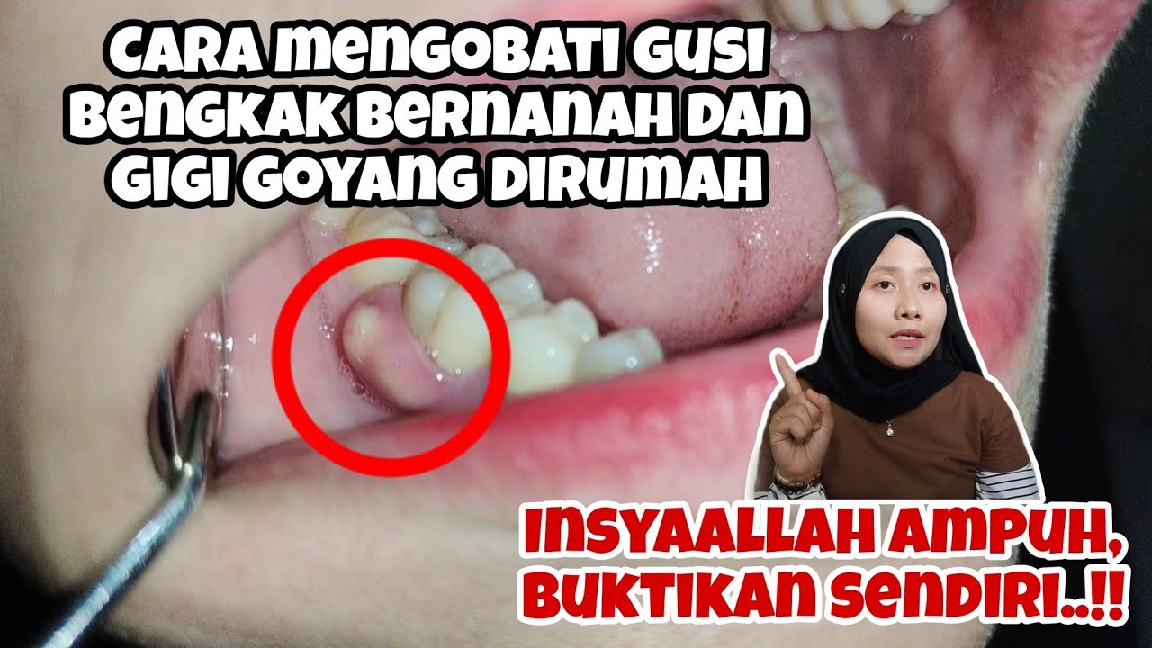Cara Ampuh Mengobati Gusi Bengkak Bernanah pada Orang Dewasa di Rumah ...