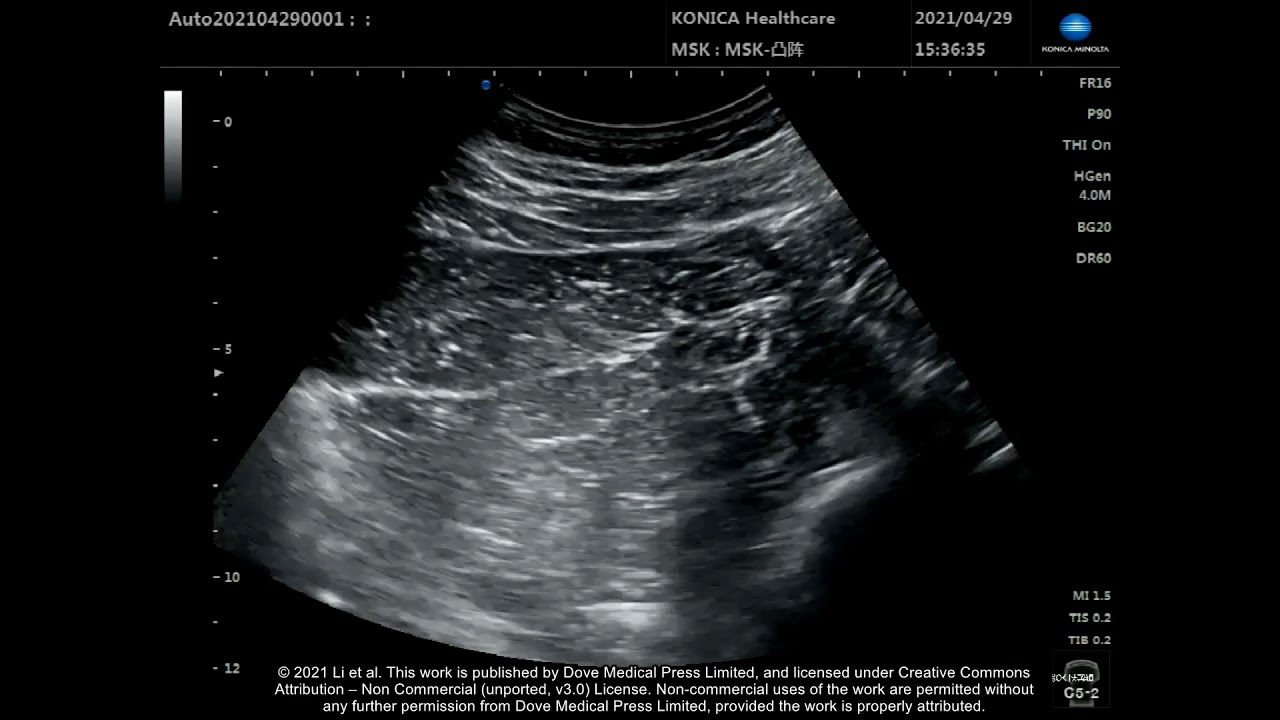 Recess between psoas major and quadratus lumborum muscles ...