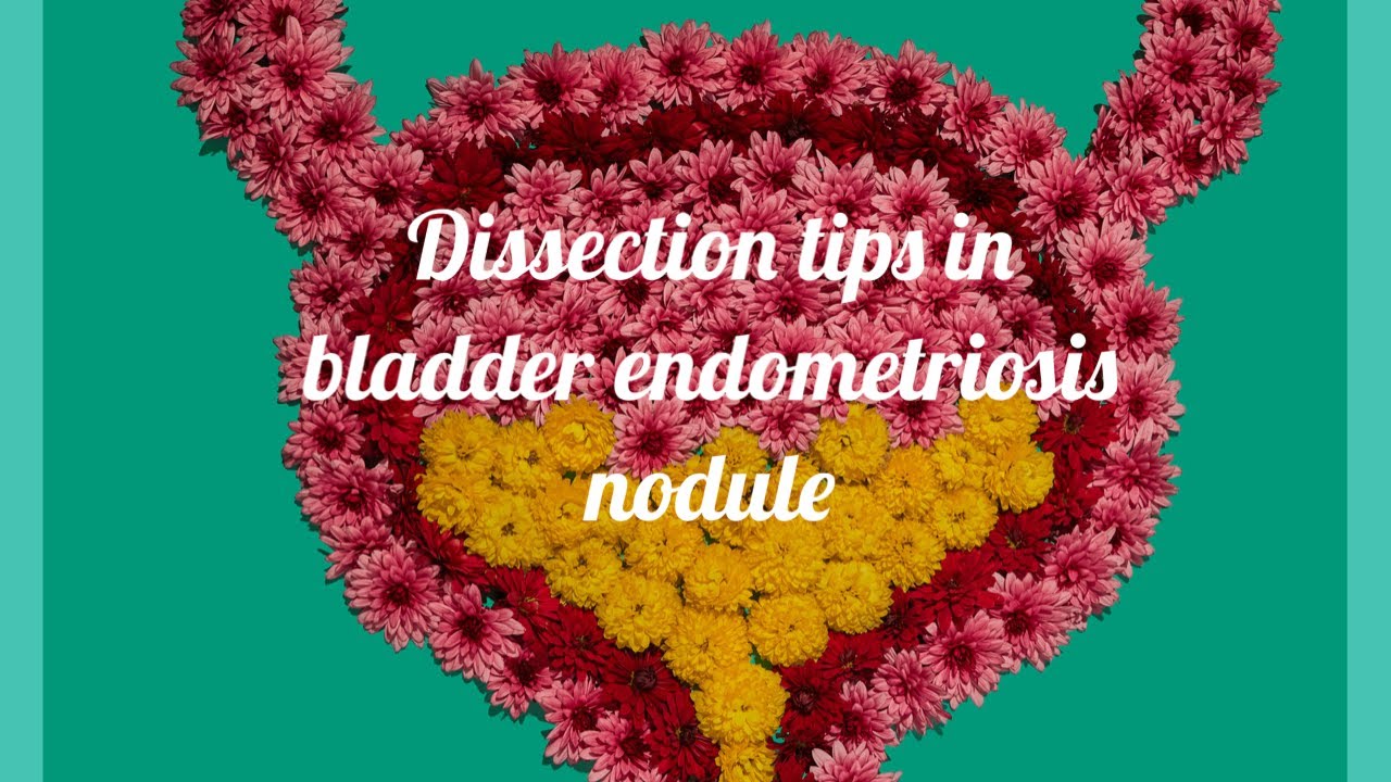 Endometriosis bladder nodule dissection - YouTube