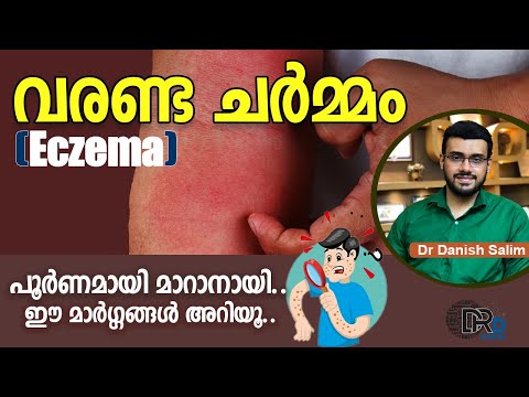 1068:🔥വരണ്ട ചർമം (എക്സീമ)  പൂർണമായി മാറാനായി.. ഈ മാർഗങ്ങൾ അറിയൂ | Dry skin: Eczema best treatment