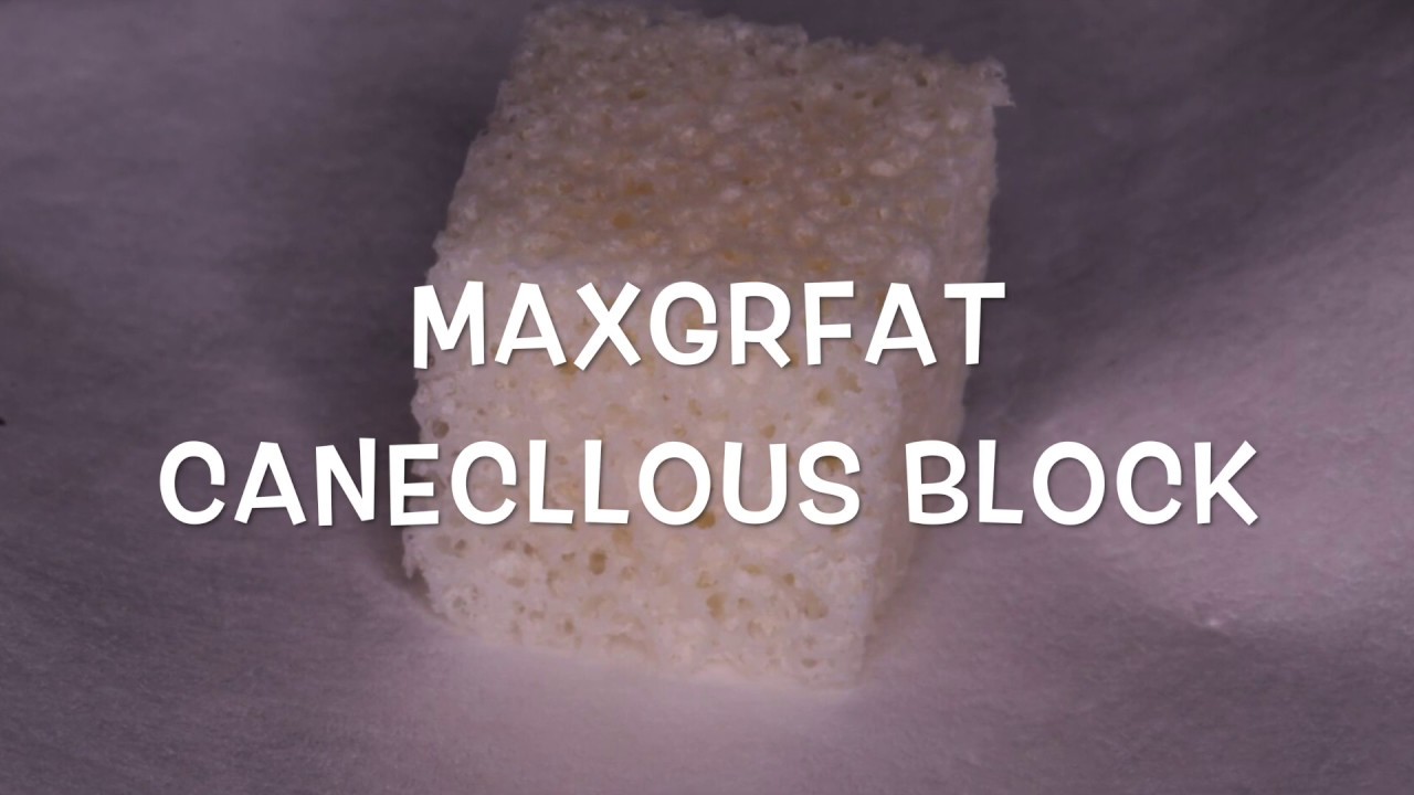 Allograft Bone Block Surgery For Implant Dentistry - YouTube