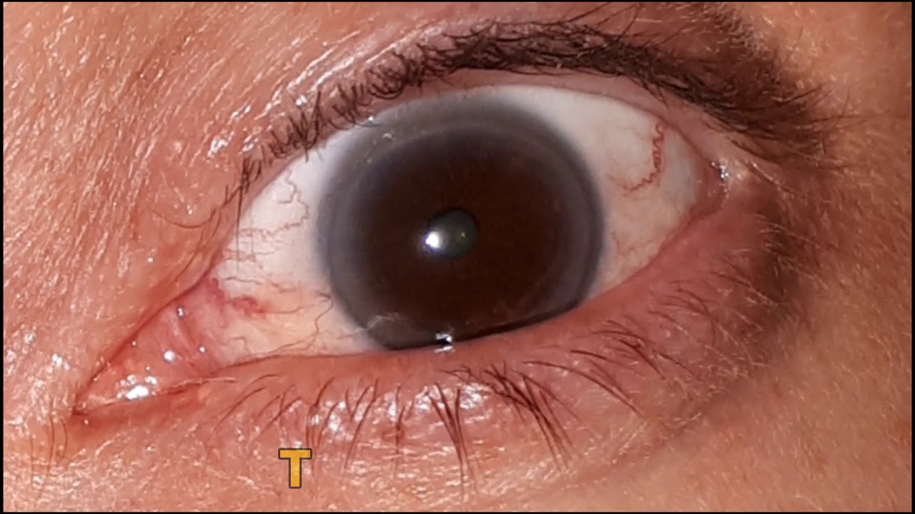 ¿Es la Tungiasis una enfermedad para la Dermatología? - YouTube