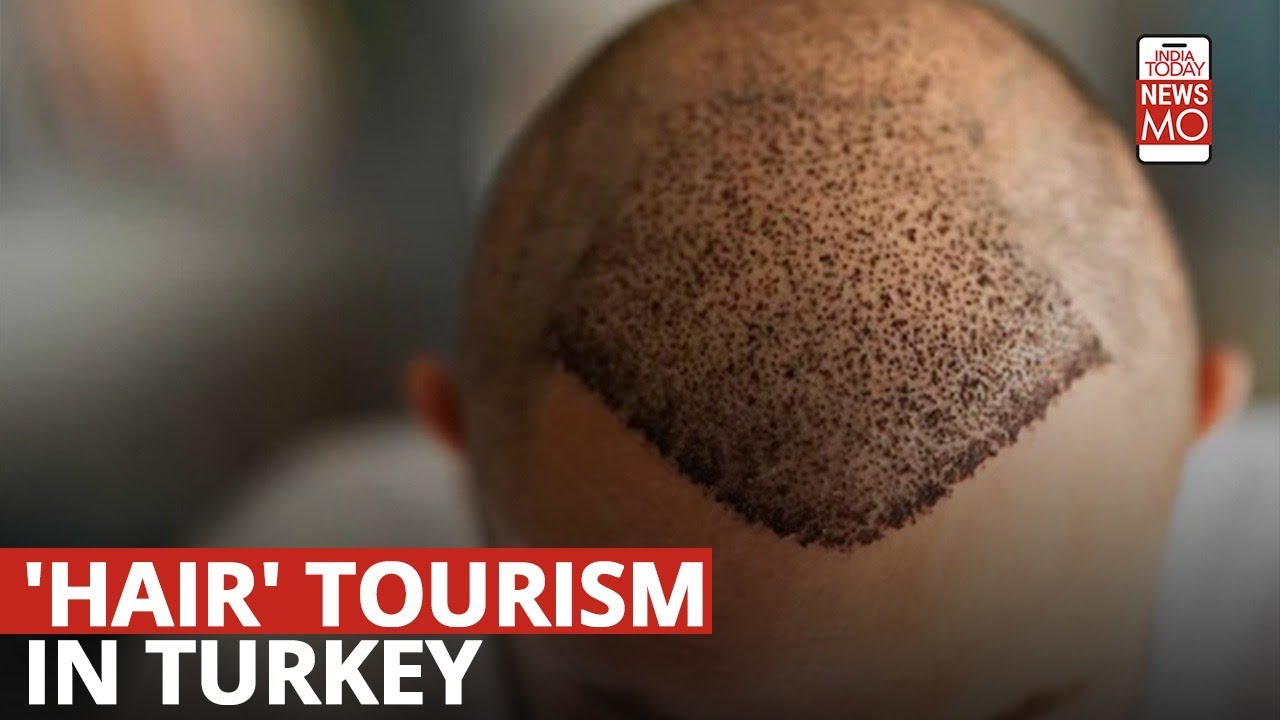‘Head’ to Turkey for hair transplant treatments- Why are people ...