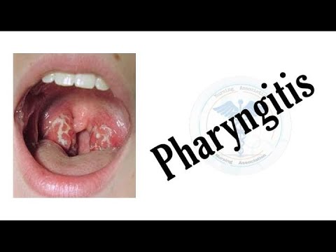 Pharyngitis Nursing Lectures Youtube