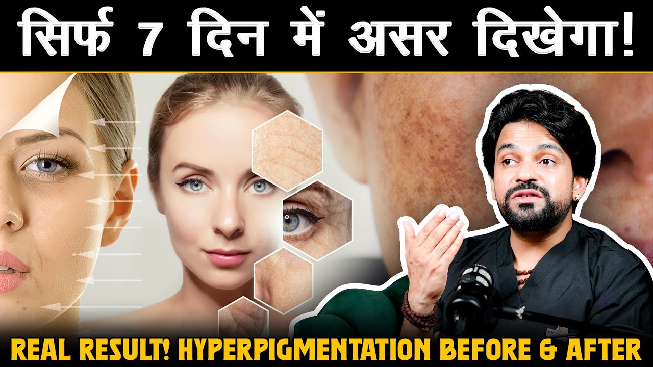 REAL RESULT! HYPERPIGMENTATION BEFORE & AFTER सिर्फ 7 दिन में असर ...