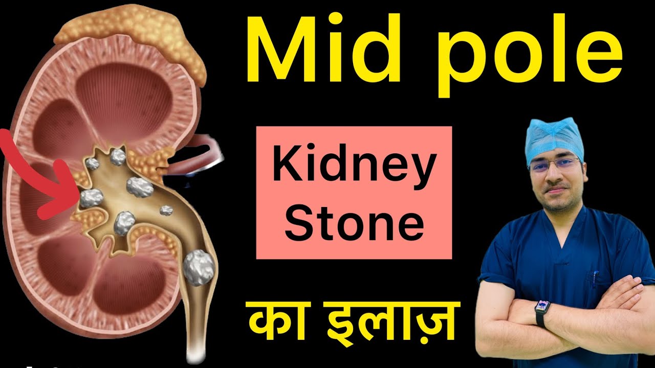 Mid Pole Kidney Stones Kidney Stones In MID Pole