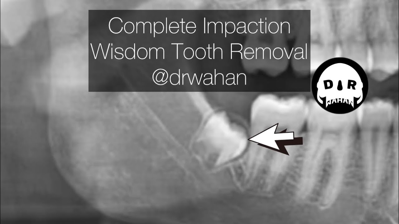 How to Extract an Impacted Wisdom Tooth @drwahan - YouTube