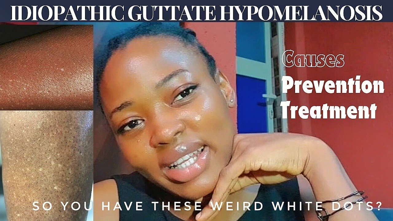 Idiopathic Guttate Hypomelanosis/ white spots on legs. - YouTube