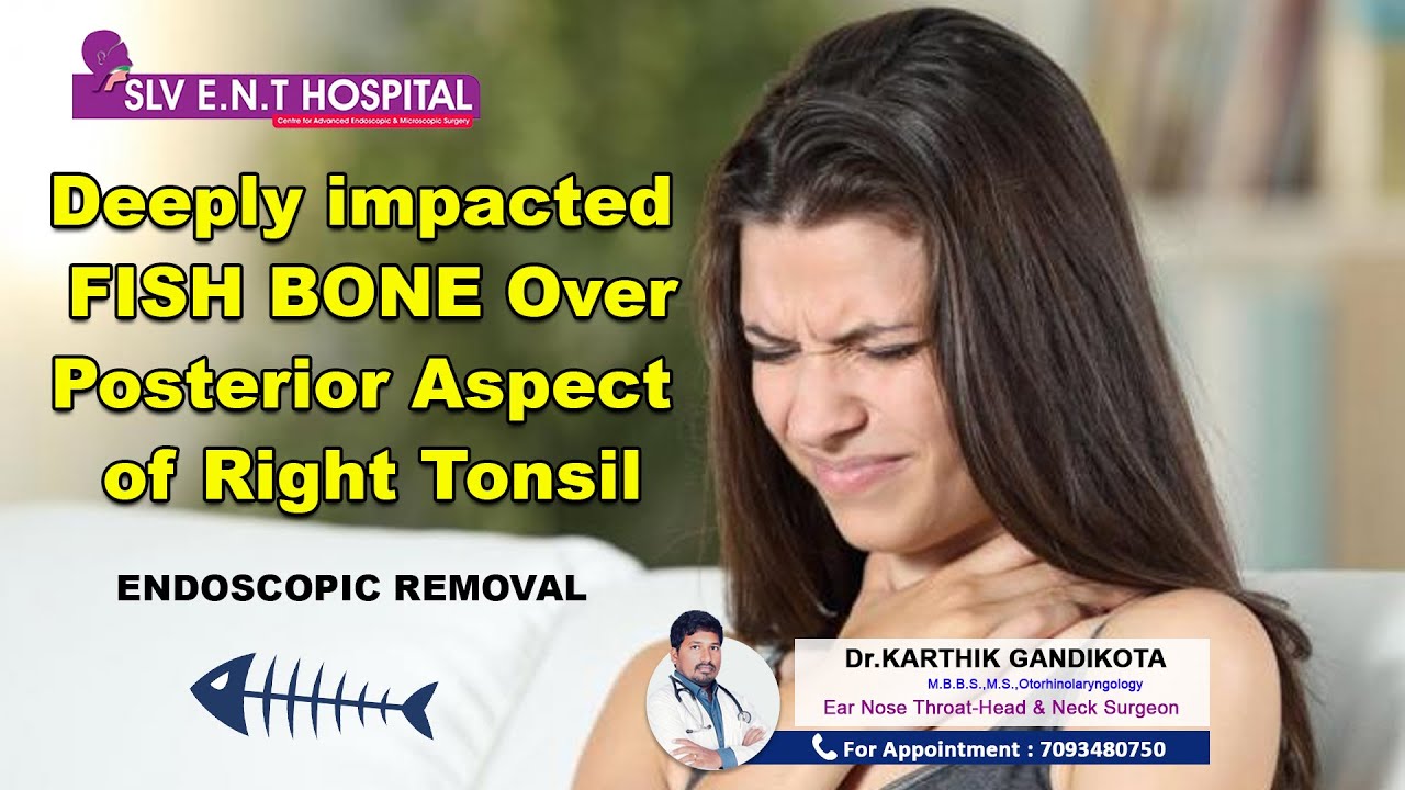 Deeply Impacted Fish Bone Over Posterior Aspect of Right Tonsil - YouTube