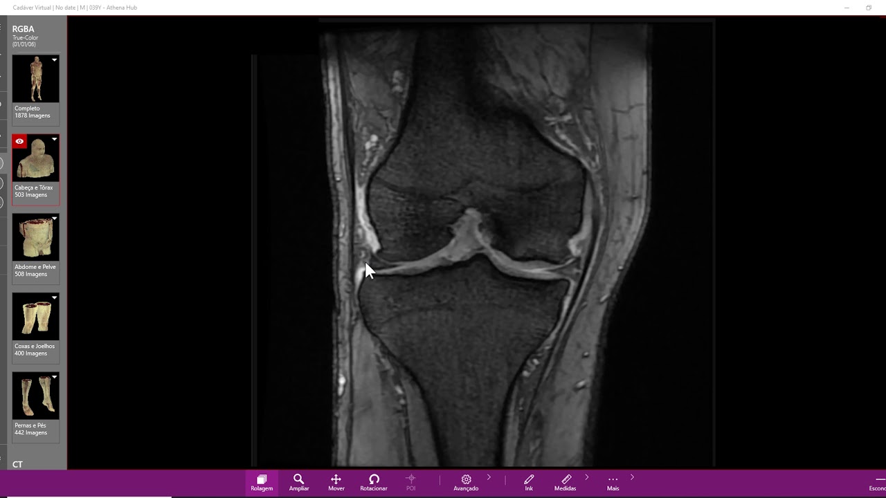 Fratura por insuficiência do côndilo femoral - YouTube