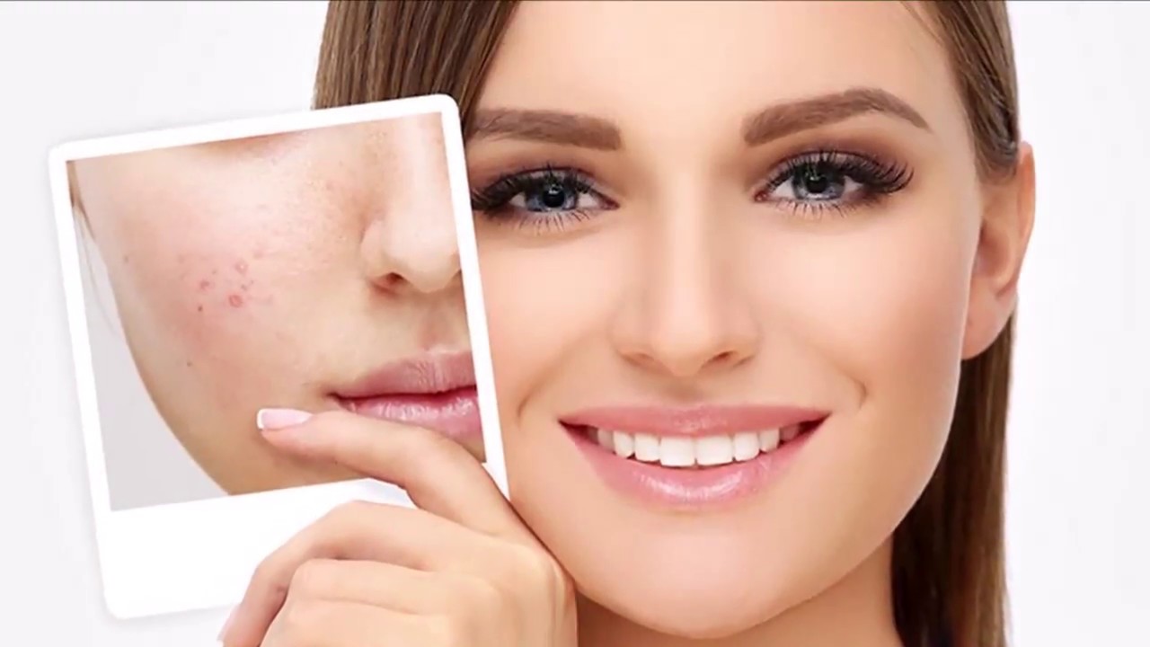 In 3 DAYS Top Remedies To Remove Black Spots On Face Completely ¦ Get ...
