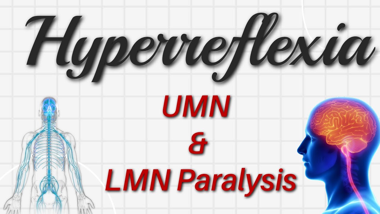 Hyperreflexia - Deep Tendon Reflex Knee Jerk Reflex #paralysis # ...