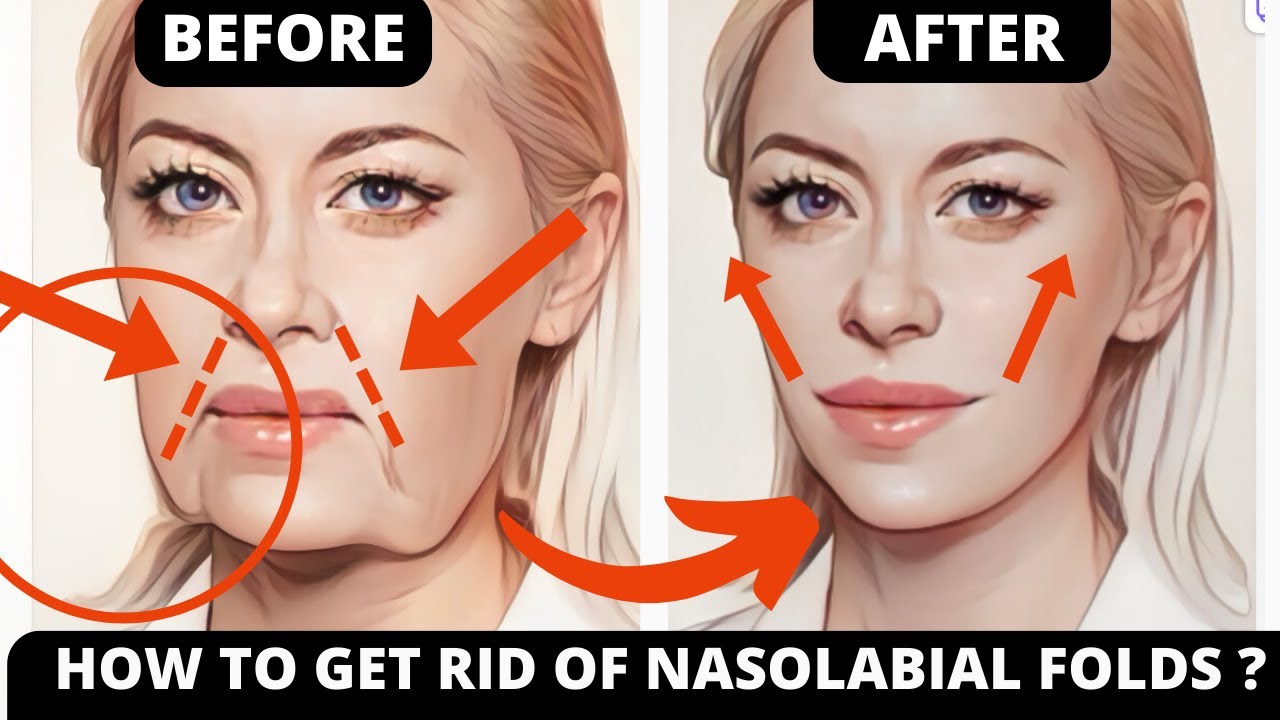EASY STEPS FOR NASOLABIAL FOLDS, LAUGH LINES | REMOVE SMILE LINES ...