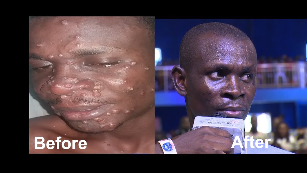 THE CURE FOR MONKEY POX - YouTube