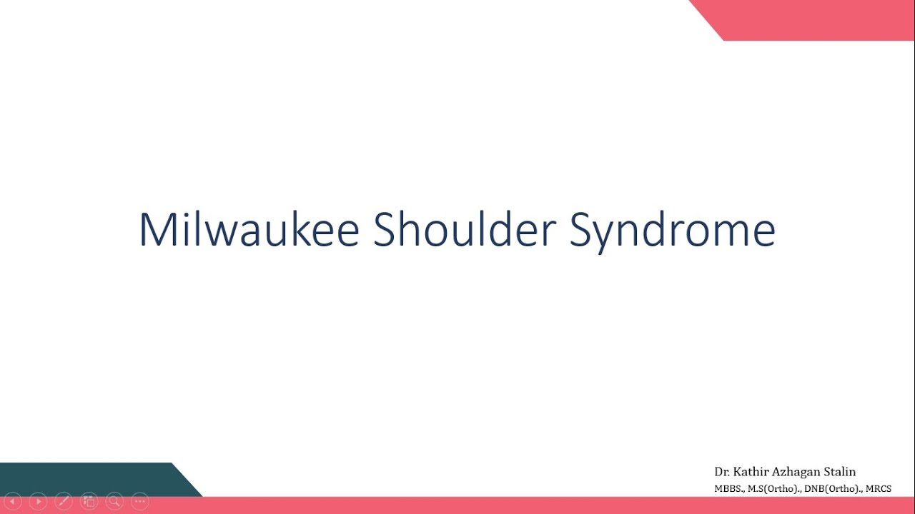 Milwaukee Shoulder Syndrome - Dr. Kathir Azhagan Stalin - YouTube