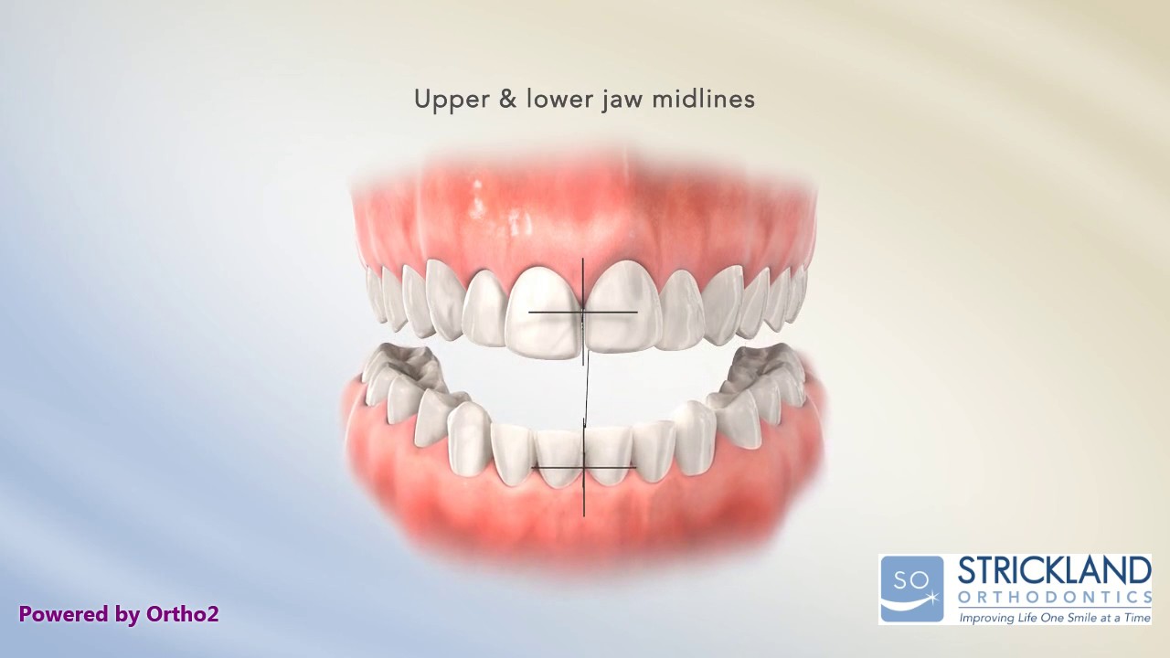 Unilateral Posterior Crossbite-left SO - YouTube